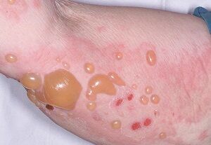 Skin Lesions: Know Everything- Cause, Types, And Symptoms