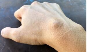 Skin Lesions: Know Everything- Cause, Types, And Symptoms