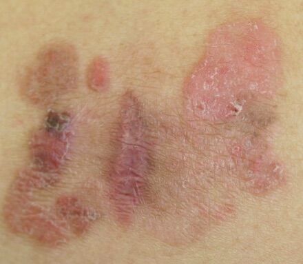 Skin Lesions: Know Everything- Cause, Types, And Symptoms