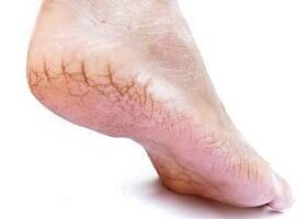 Skin Lesions: Know Everything- Cause, Types, And Symptoms