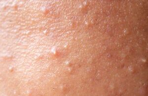 Skin Lesions: Know Everything- Cause, Types, And Symptoms