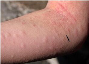 Skin Lesions: Know Everything- Cause, Types, And Symptoms